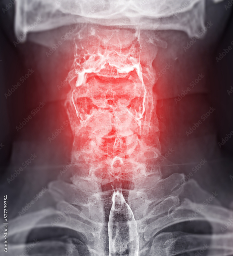 Barium Swallow study test diagnose Barrett's GI tract exam GERD ulcers ...