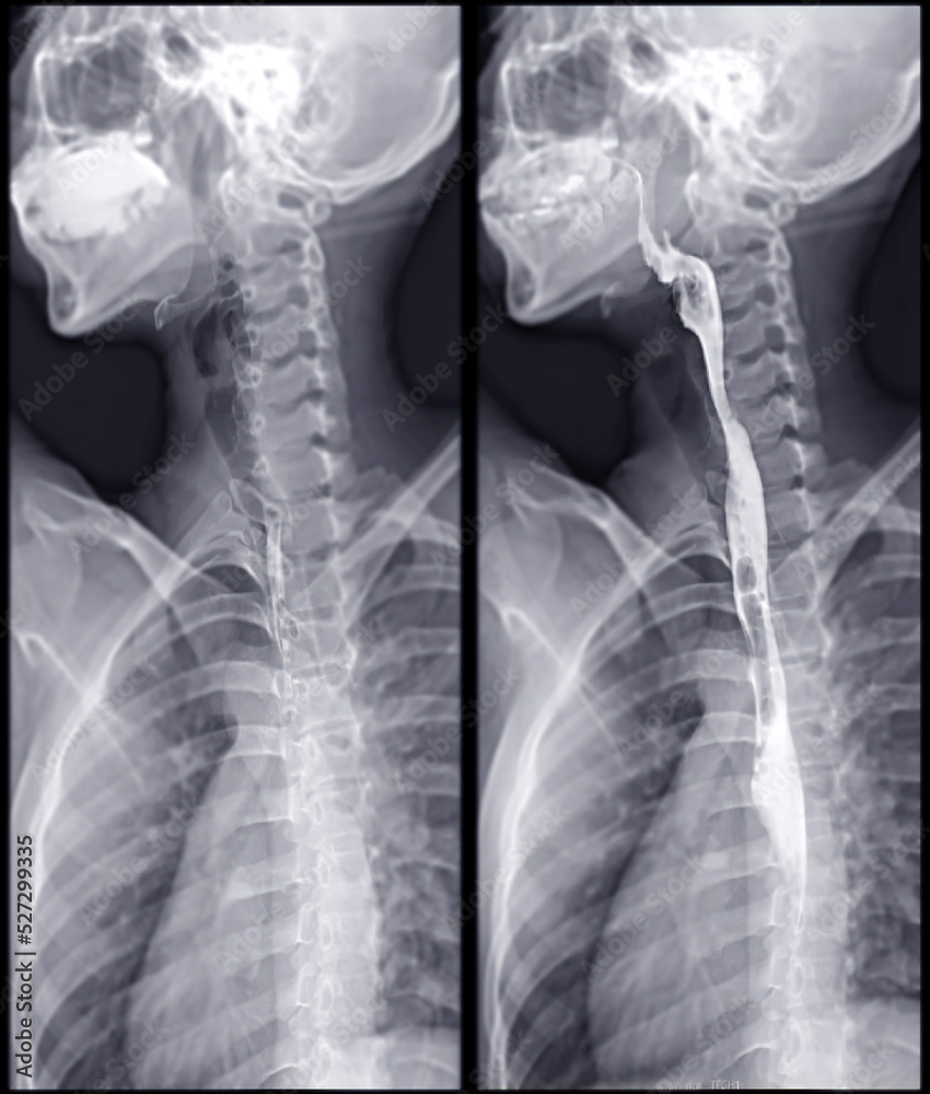 Fototapeta Barium Swallow study test diagnose Barrett's GI tract exam ... Fototapeta Barium Swallow study test diagnose Barrett's GI tract exam ...