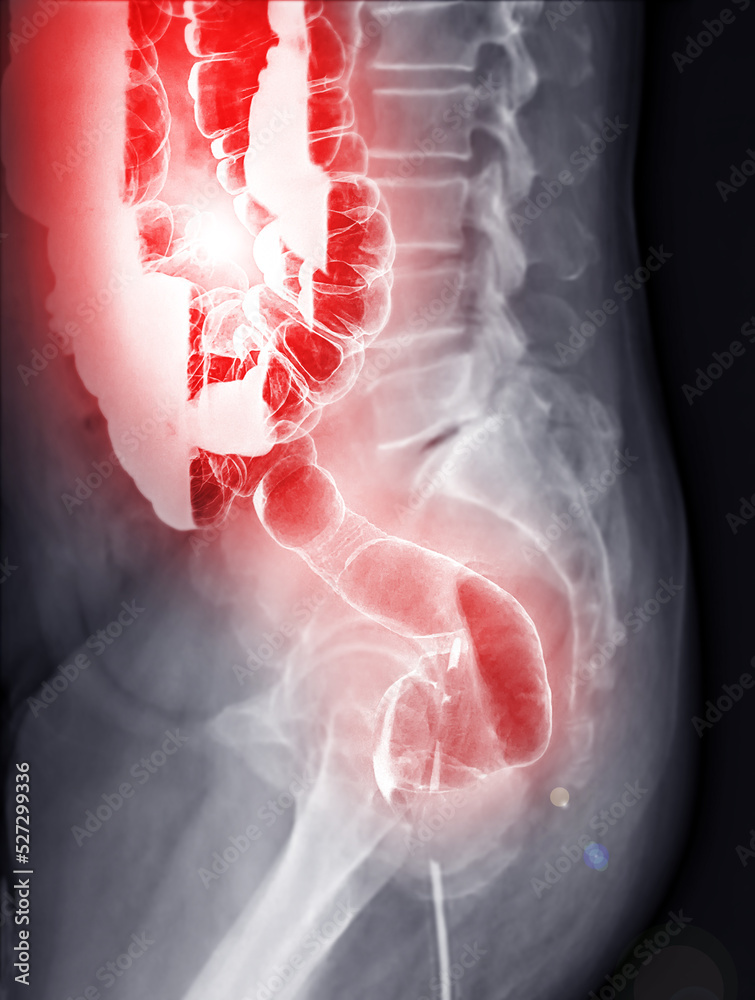 Barium enema or BE is image of large bowel after injection of barium ...
