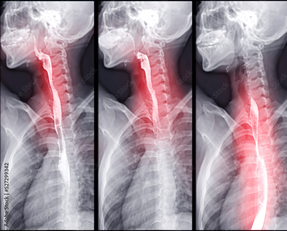 Póster Barium Swallow study test diagnose Barrett's GI tract exam GERD ...