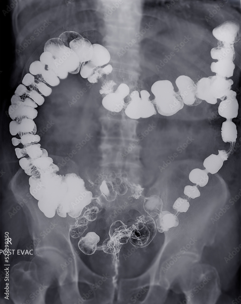Barium enema or BE is image of large bowel after injection of barium ...