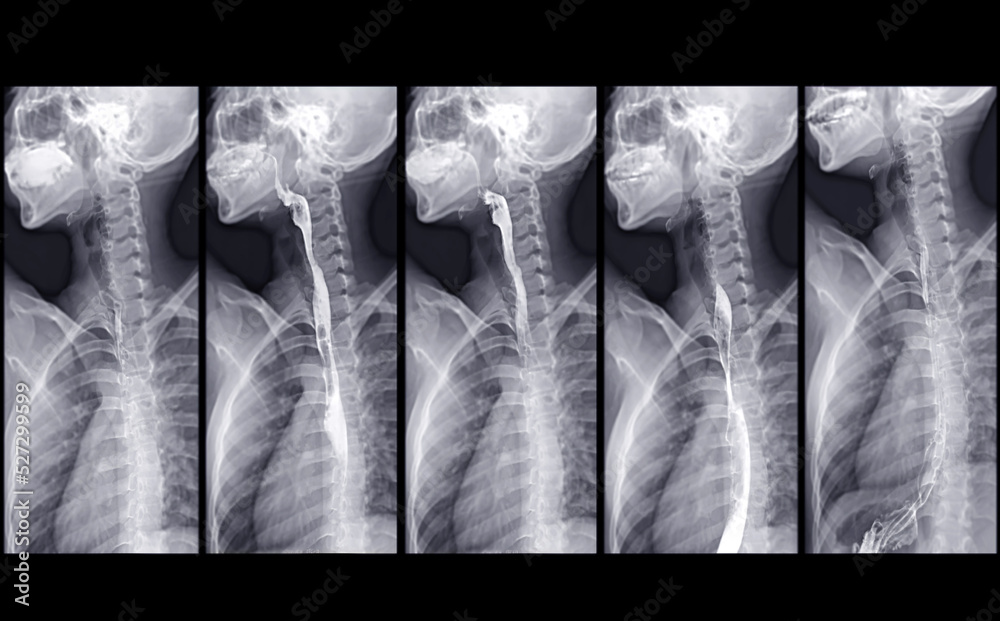 Barium Swallow study test diagnose Barrett's GI tract exam GERD ulcers ...