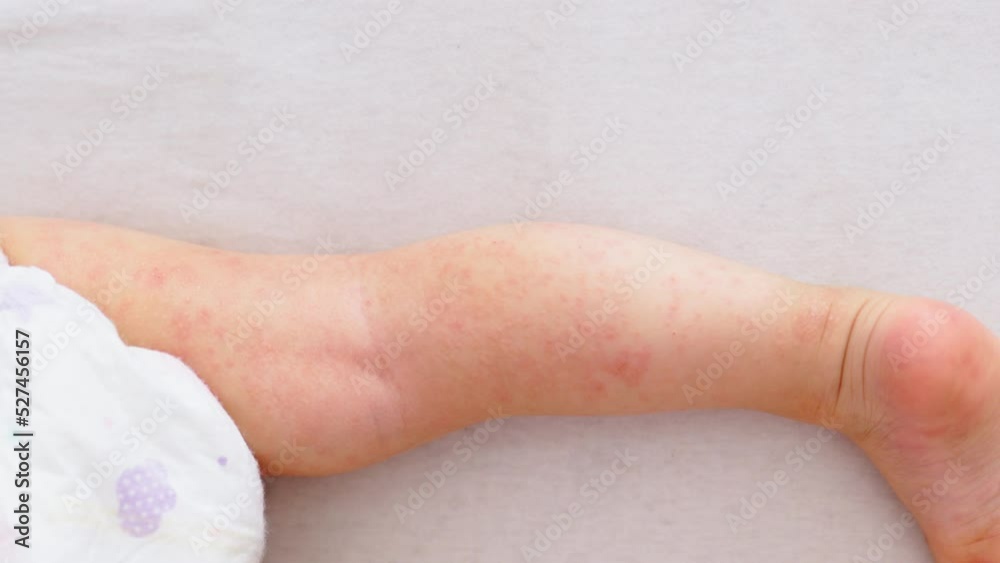 allergic skin on child's legs, red rash dermatitis, close-up atopic ...