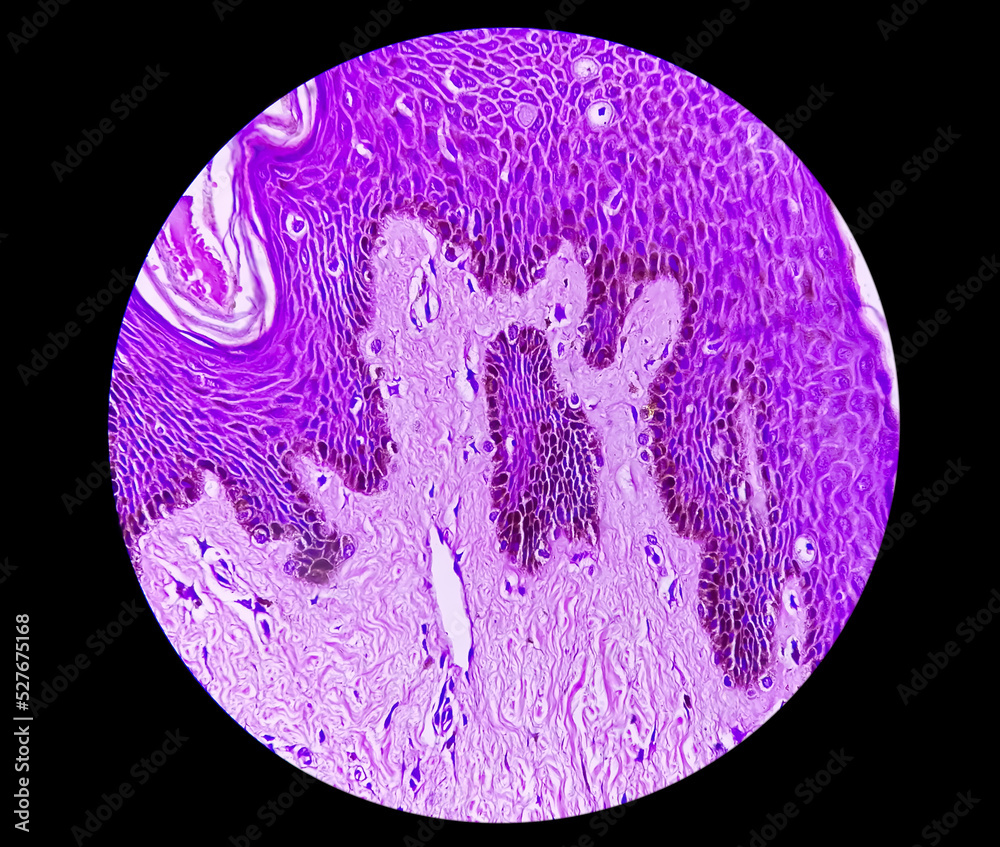 Histological biopsy of Scrotal wall under microscopy showing Calcinosis ...
