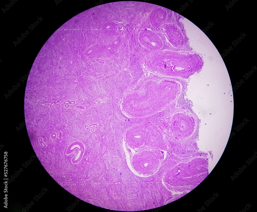 Poster Histological examination of uterus biopsy suggestive uterine ...