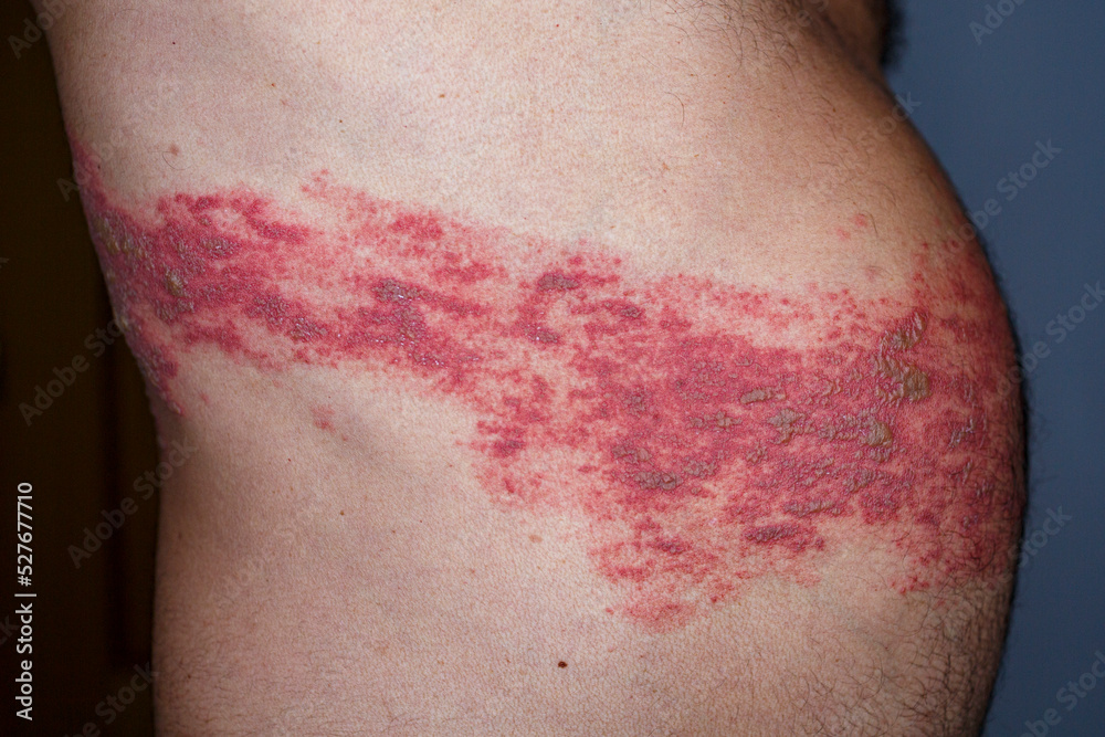 Skin lesion symptom in Shingles or Herpes zoster in human. Shingles or Herpes zoster is aviral ...