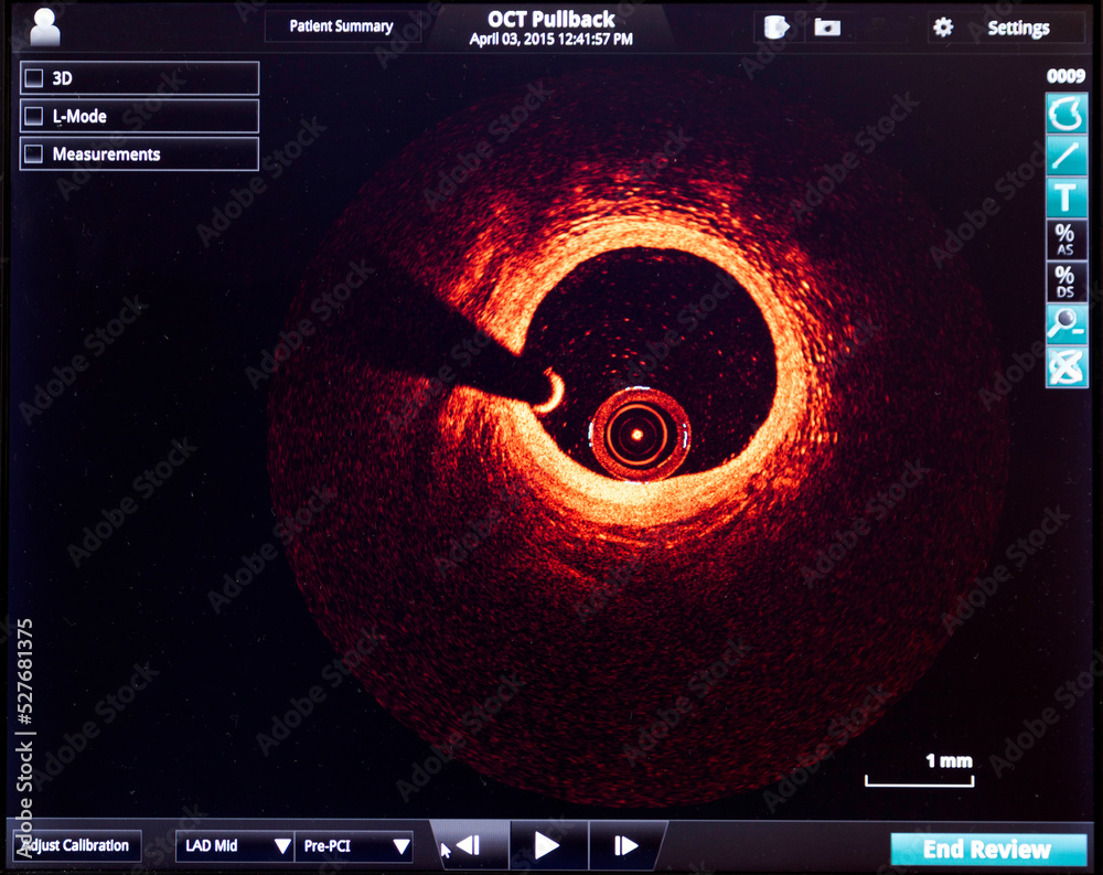 intravascular optical coherence tomography oct image angiography ...