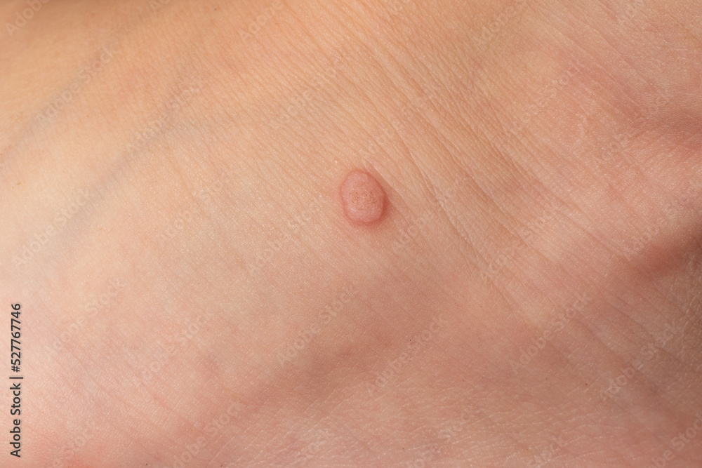 Common wart Verruca vulgaris on the skin of a child. Stock Photo ...