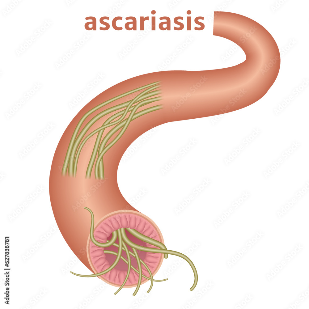 Ascariasis. Parasites in the small intestine. Body infection. Vector ...