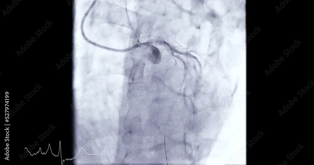 Coronary angiogram of coronary artery during cardiac catheterization in ...
