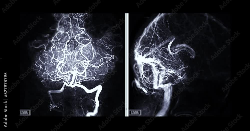 Cerebral angiogram for diagnosis abnormalities such as cerebral artery ...