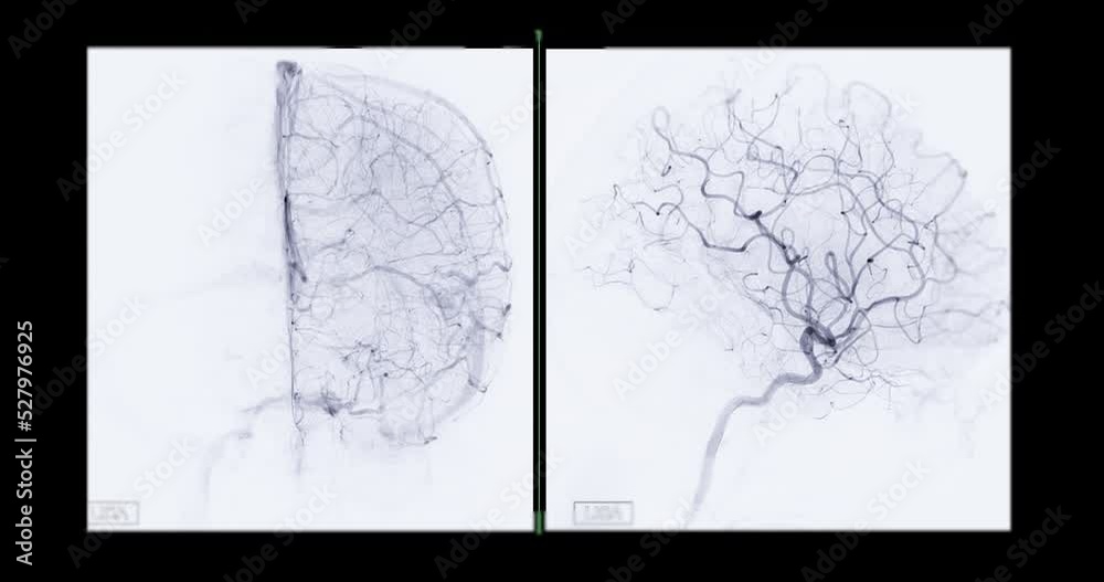 Cerebral angiogram for diagnosis abnormalities such as cerebral artery ...