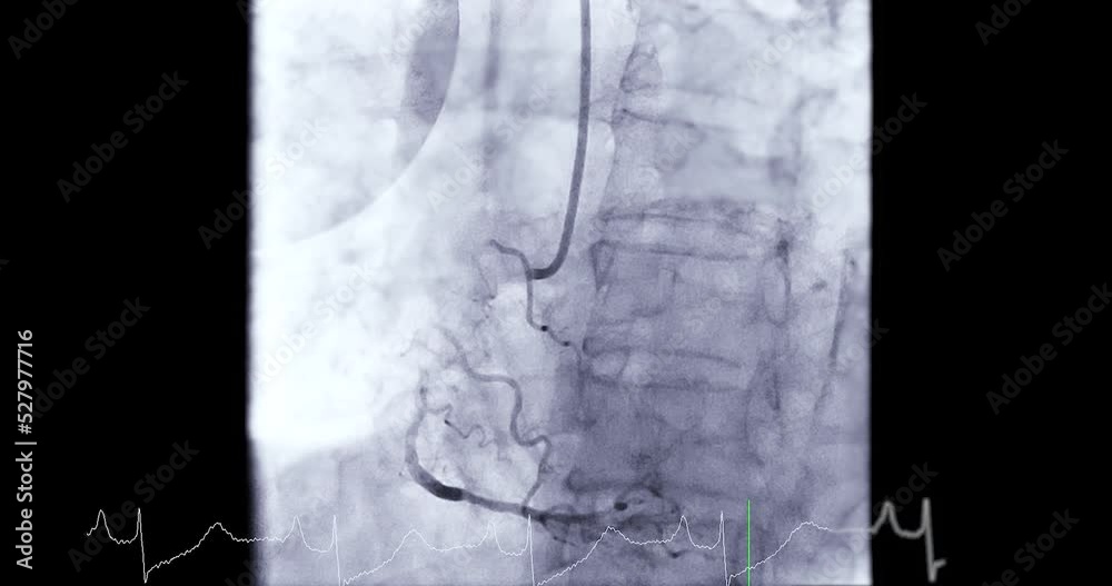Vidéo Stock Coronary angiogram of coronary artery during cardiac ...