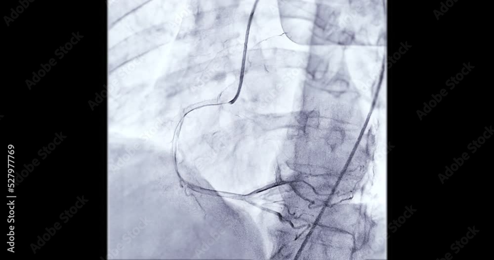 Coronary angiogram of coronary artery during cardiac catheterization in ...