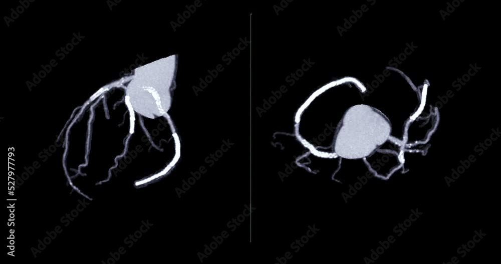 CTA Coronary artery 3D rendering image s detect coronary artery disease ...