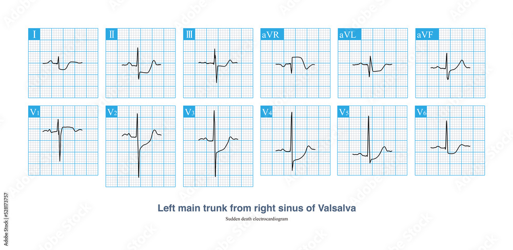 An 11 year old boy had sudden chest pain after playing football ...