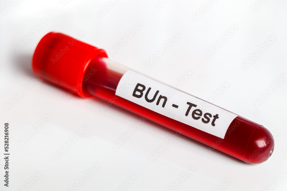 BUn test from blood , Blood samples to be analyzed in the laboratory ...