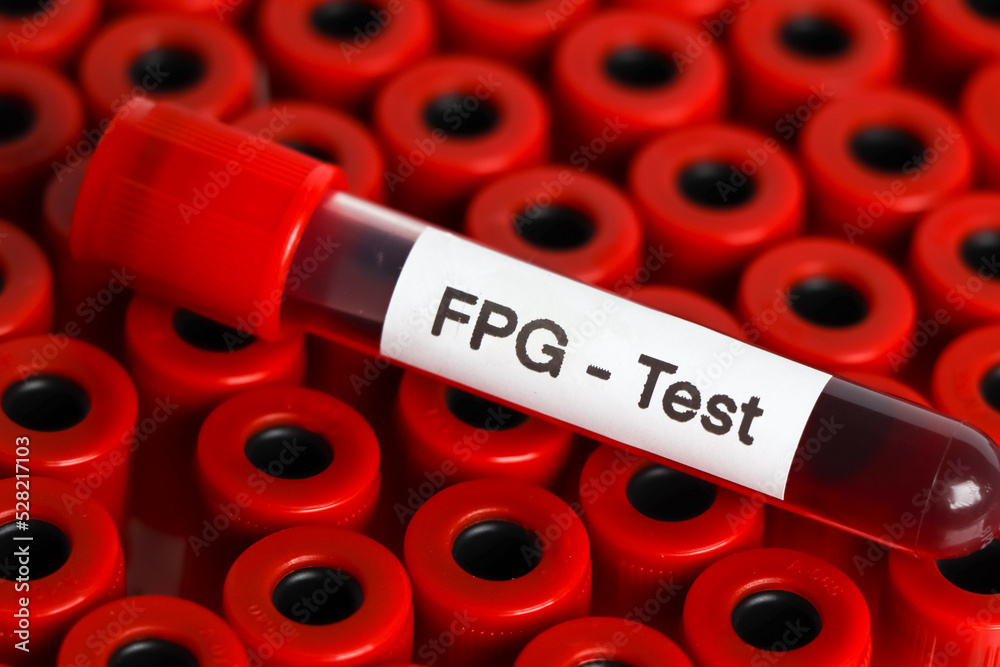 FPG-test from blood , Blood samples to be analyzed in the laboratory ...