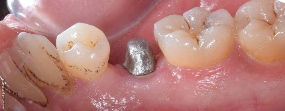 Inlaycore scemented in an inferior premolar root. Lingual view of the ...