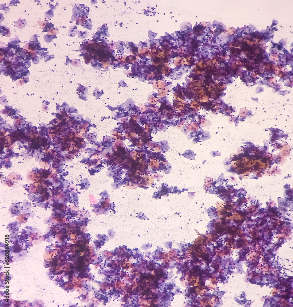 Abnormal squamous epithelial cells view in microscopy.HPV criteria for ...