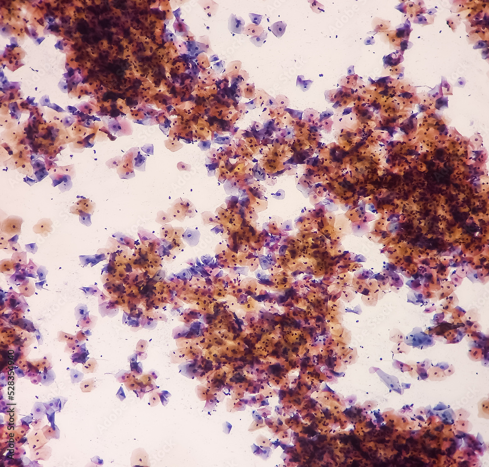 Abnormal squamous epithelial cells view in microscopy.HPV criteria for ...