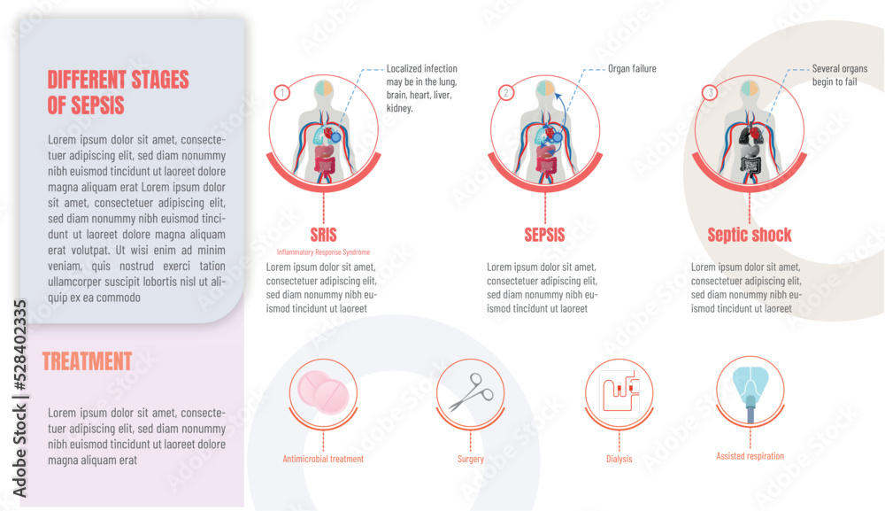 Infographics, evolution of sepsis stages and possible treatments Stock ...
