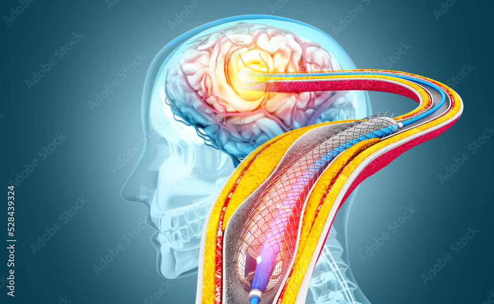 Atherosclerosis Stroke, A blood clot in the vessels of the human brain ...