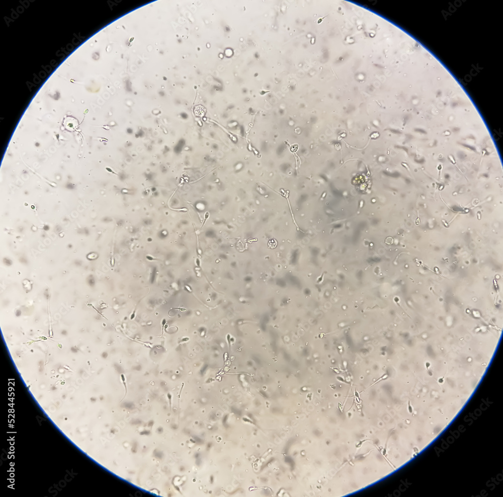 Semen analysis under microscopy showing Pyospermia or leukocytospermia ...