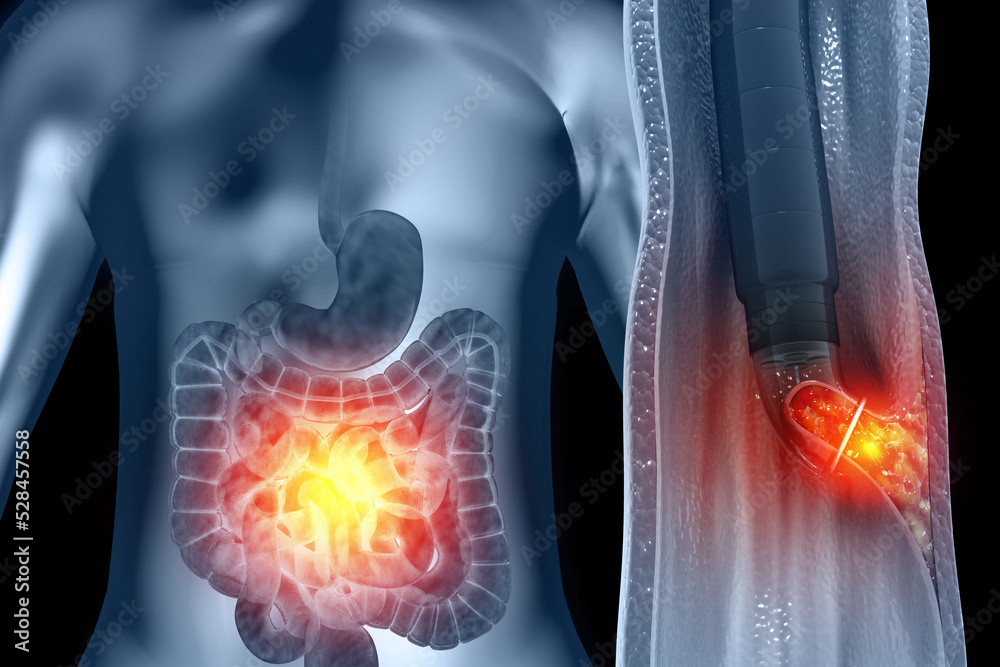 colon cancer. colonoscope in the colon. polyp removal. 3d illustration ...