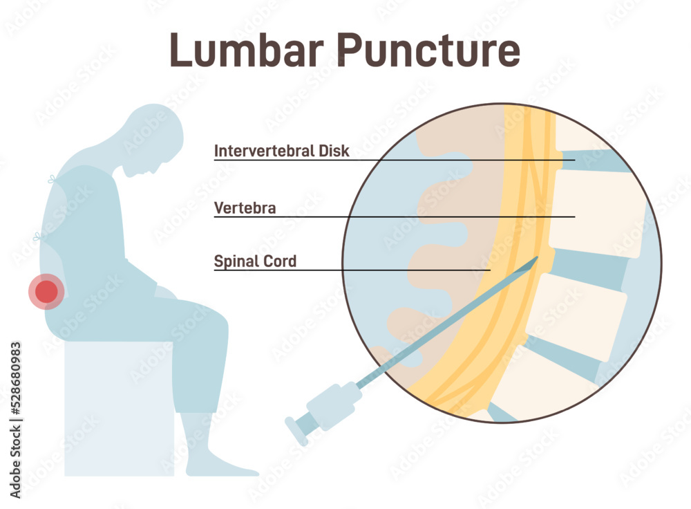 Subarachnoid Space Lumbar Puncture