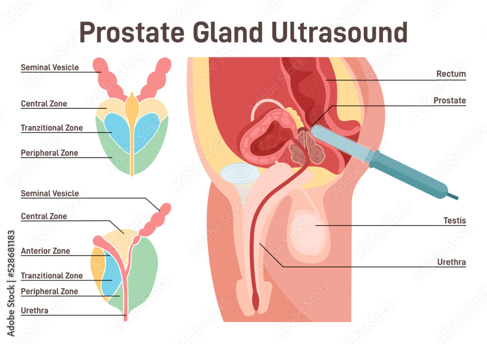 Prostate gland ultrasound. Rectal exam of prostate structure and condition. Stock Vector | Adobe ...