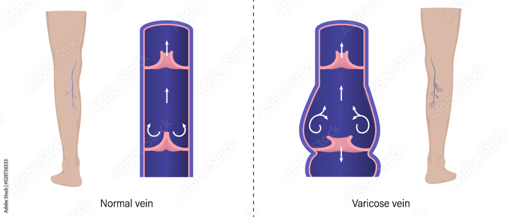 Comparison between normal veins and varicose veins in cross-sectional ...