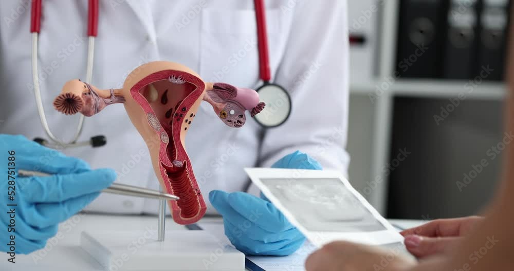 Doctor shows anatomical model of uterus with pathologies of patient ...