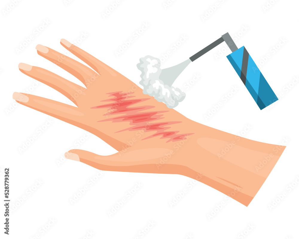 Hands injured skin and procedures of wound cleaning. First aid for ...