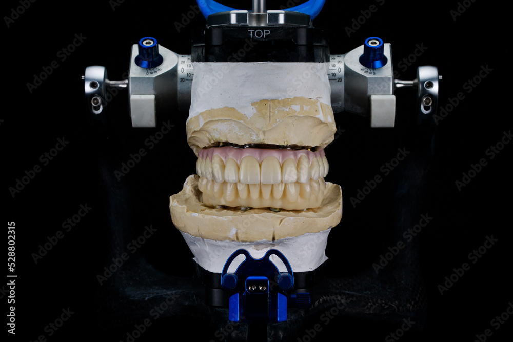 dental articulator with a fixed prosthesis and a temporary prosthesis ...
