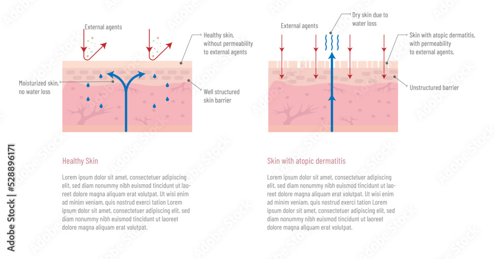 Infographic of healthy skin and skin with atopic dermatitis, how ...