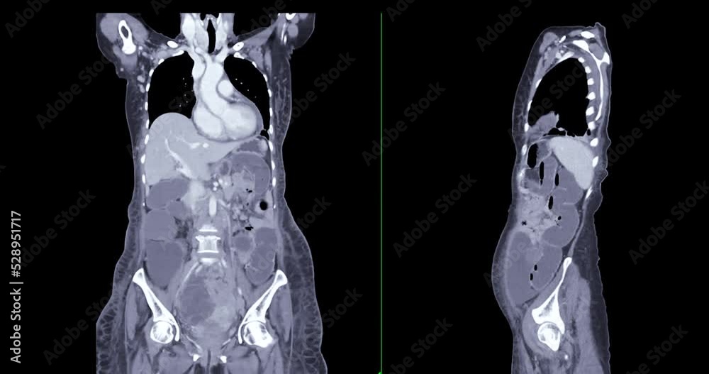 CT Chest and whole abdomen with contrast media coronal and sagittal view for diagnosis chest and ...