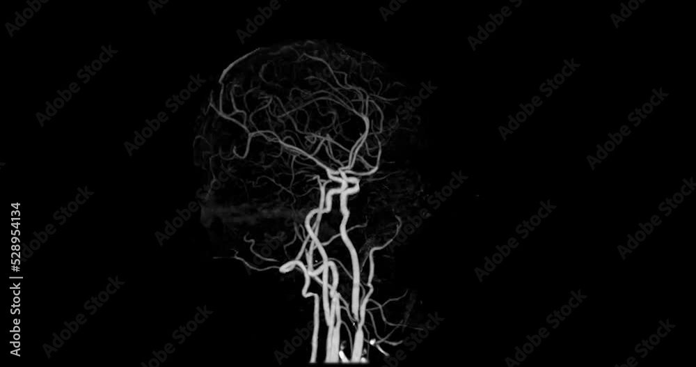CTA brain or Computed tomography angiography of the brain 3D Rendering ...