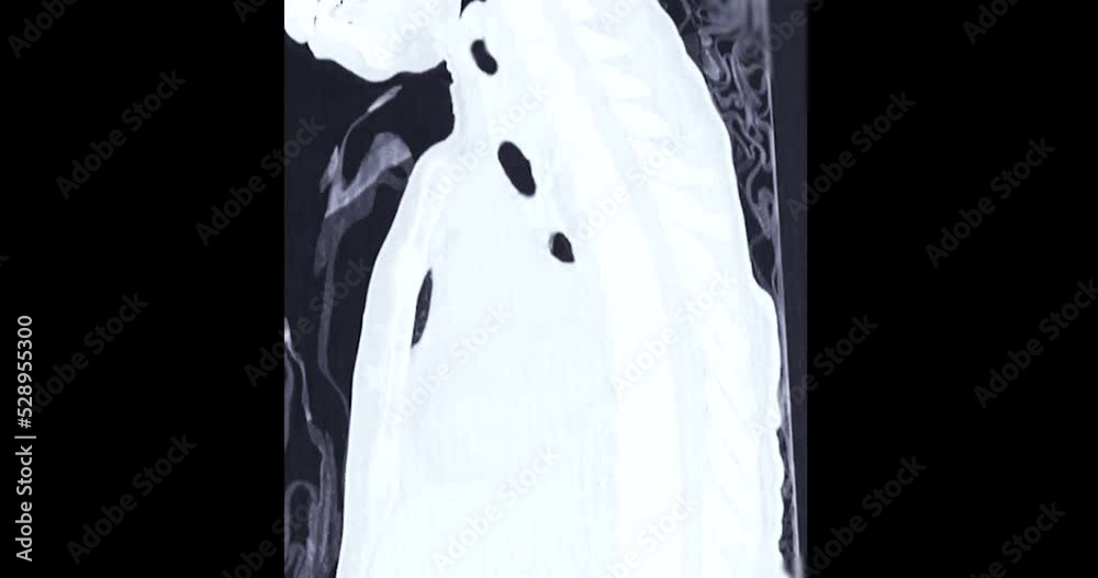 CT Chest or CT Scan of Lung sagittal MIP View for diagnosis TB,tuberculosis and coronavirus or ...