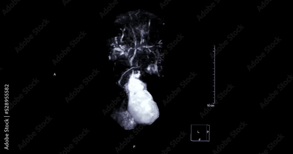 Magnetic resonance cholangiopancreatography or MRCP 3D MIP view showing ...