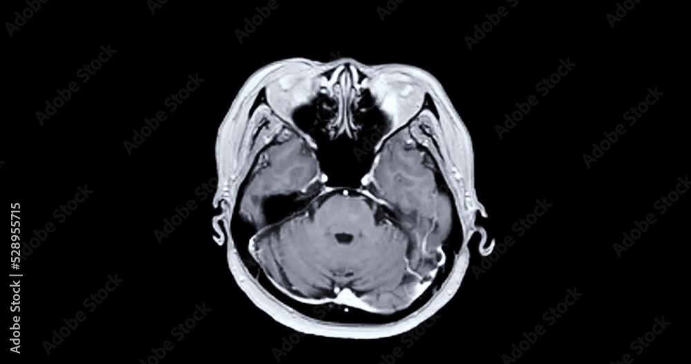 MRI of the brain Axial T1 FS technique after injection gadolinium ...