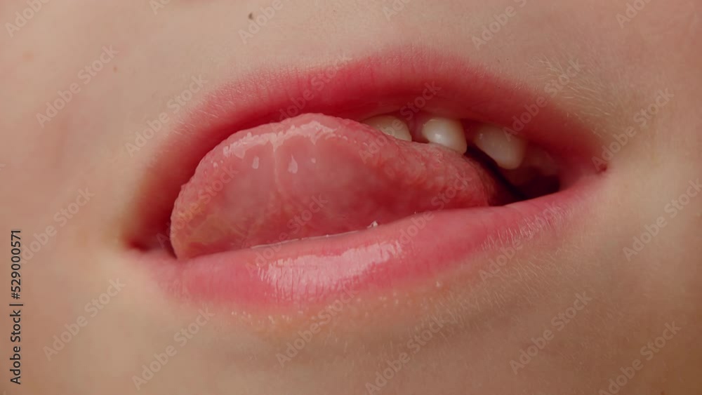 Close up Child s Mouth Pulling Out Milk Tooth Change Of Teeth Loss Of close-up-child-s-mouth-pulling-out-milk-tooth-change-of-teeth-loss-of