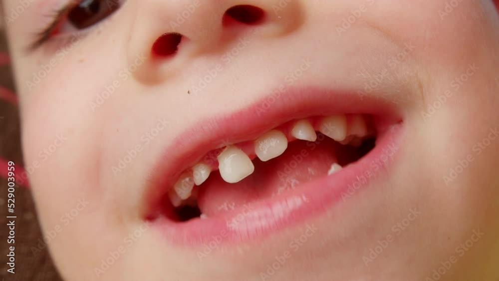 Close-up portrait child mouth pulling out milk tooth. Change of teeth ...