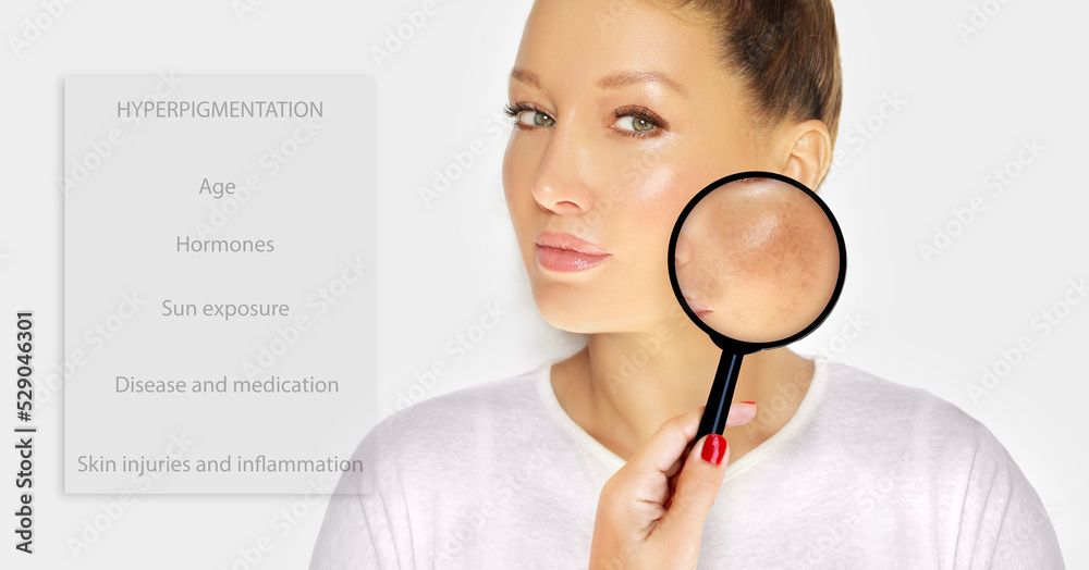 Dark spots, freckles,hyperpigmentation(melasma or chloasma),concept ...