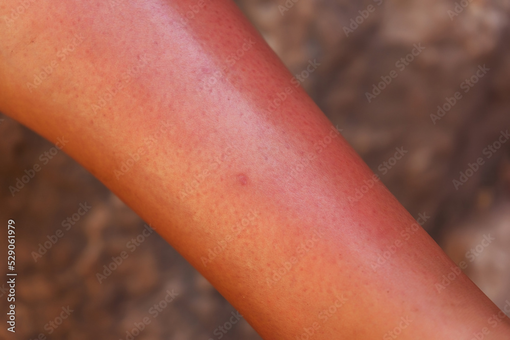 sunburn on human skin. red skin from the sun on the girl's leg ...