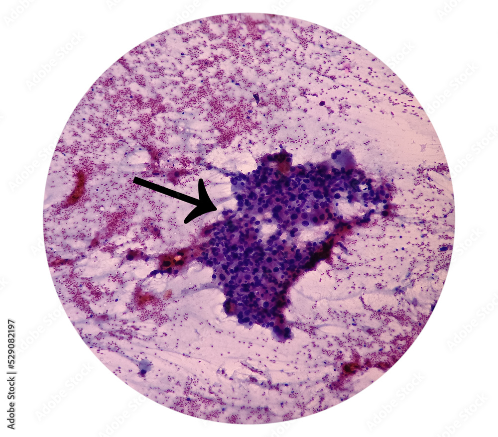 Intra abdominal mass(Cytology): Spindle cell sarcoma, positive ...
