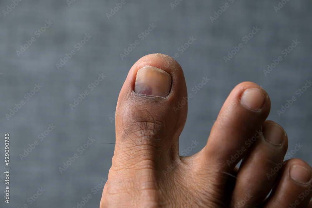 Toenail cuts and bruises. Concept illustration of the need for health ...
