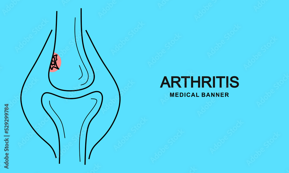 Joint pain banner. Bone, injury, disease. Arthritis concept. Can be ...