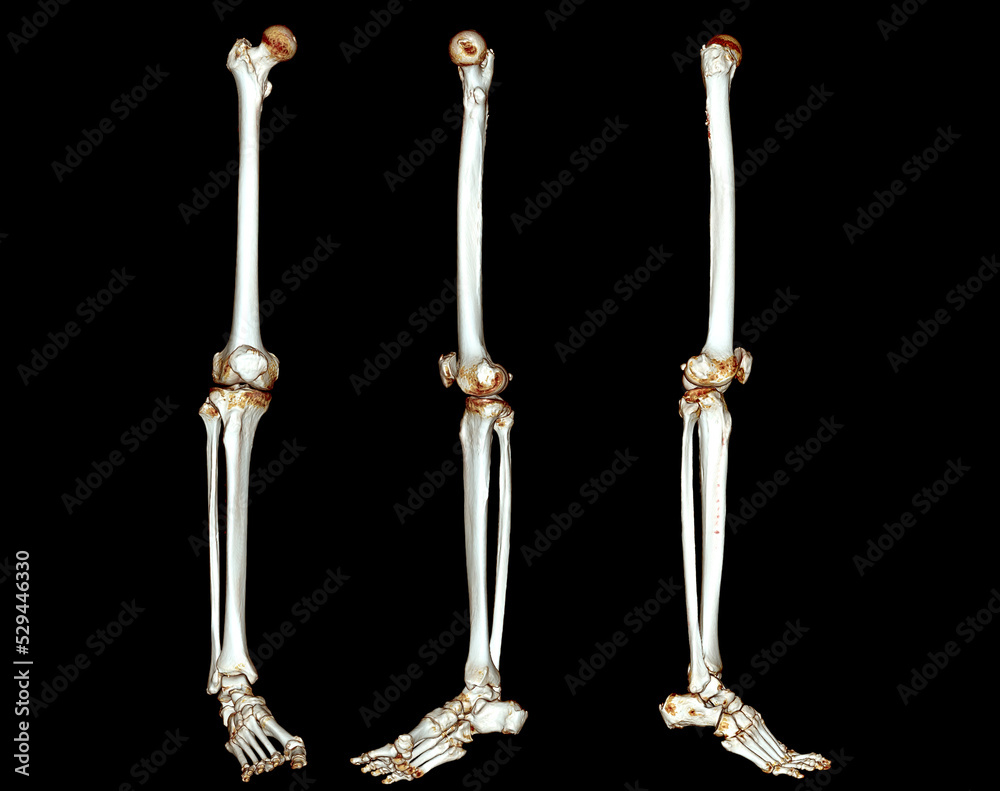 CT scan of lower extremity 3D . Stock Photo | Adobe Stock