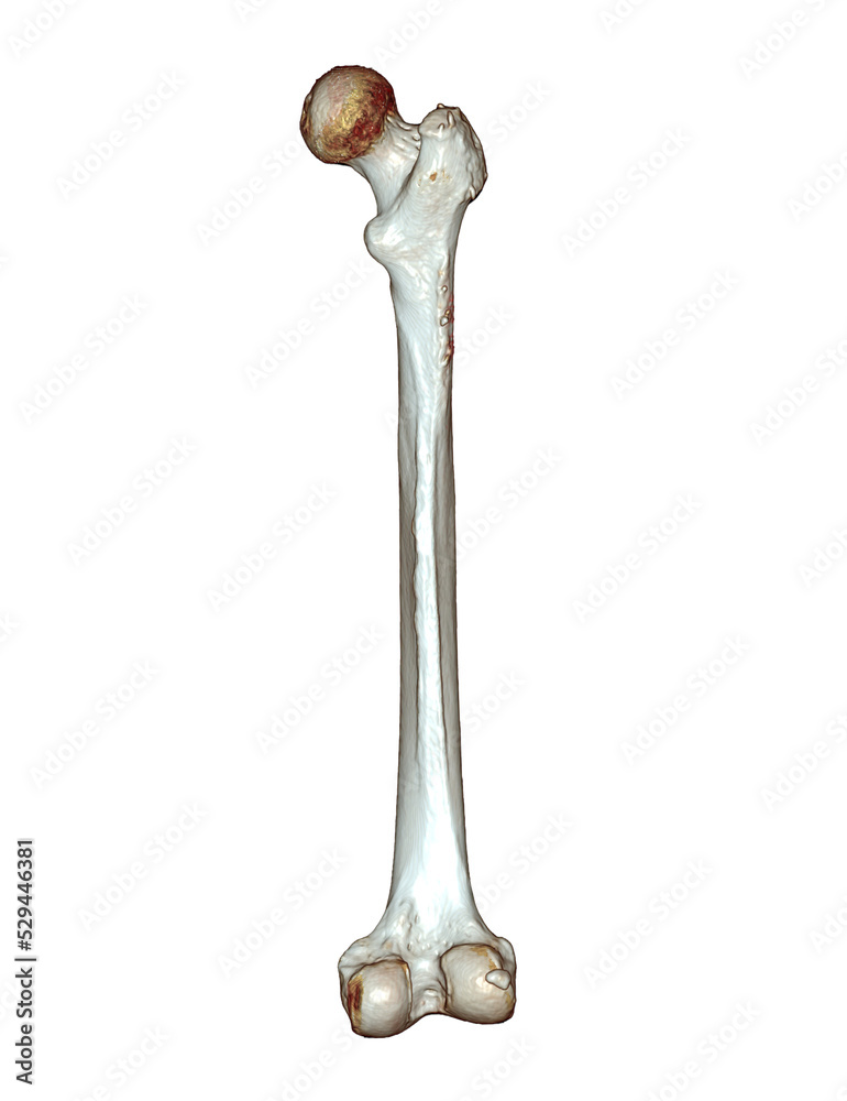 CT scan of Femur bone 3D . Stock Photo | Adobe Stock